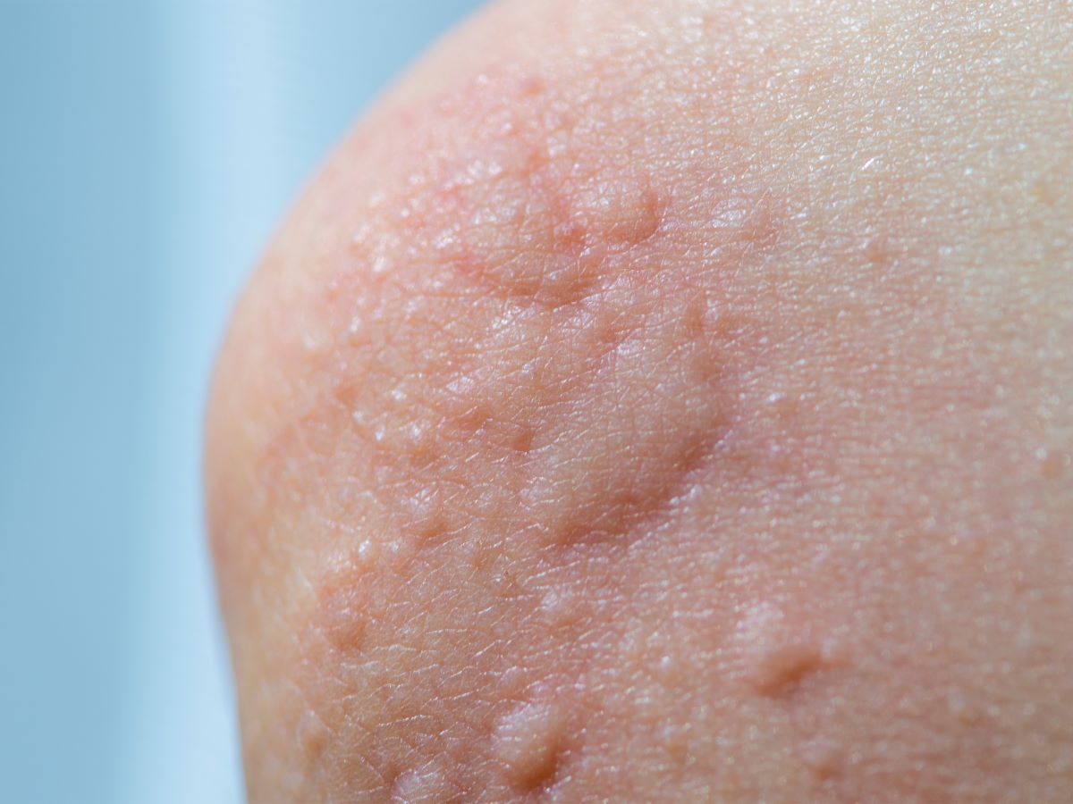 סרפדת, או בשמה הרפואי אורטיקריה - פנדה - מרפאה משפחתית